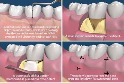 Periodontal Disease Treatment Houston TX | Texas Periodontal Associates